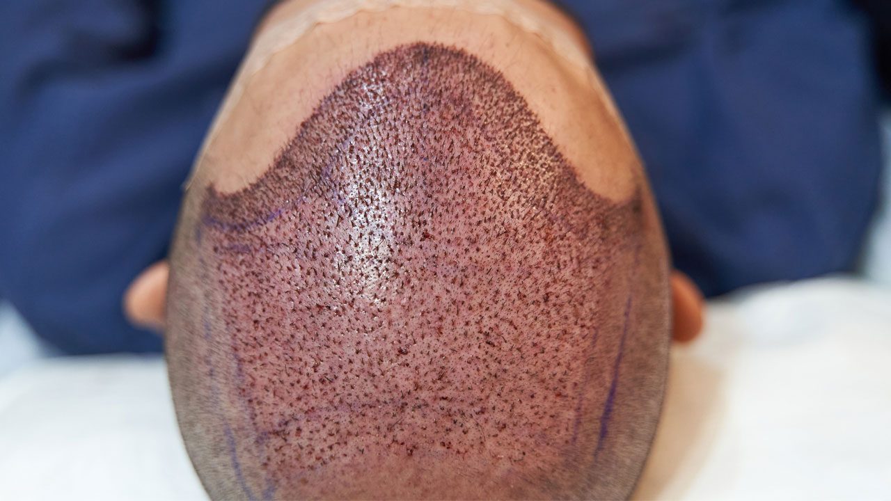 What Is Scalp Micropigmentation? - Australian Therapeutic Skincare ...